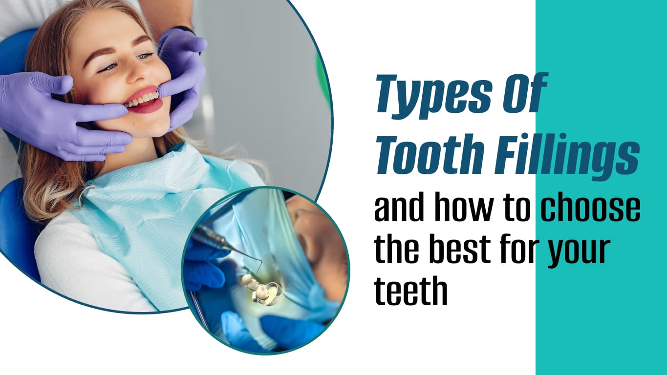 Types of Tooth Fillings & How to Choose the Best