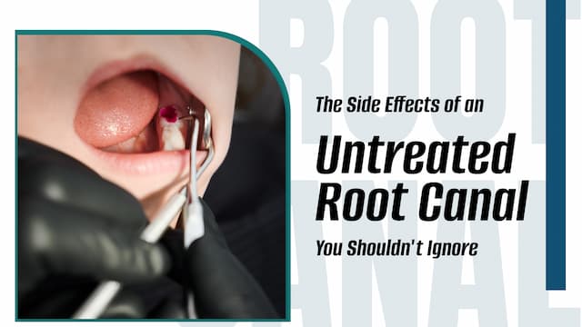 What Happens If a Root Canal Is Left Untreated? Key Side Effects